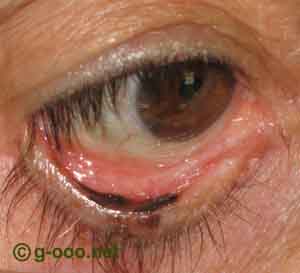 Tumores Da Conjuntiva Melanoma